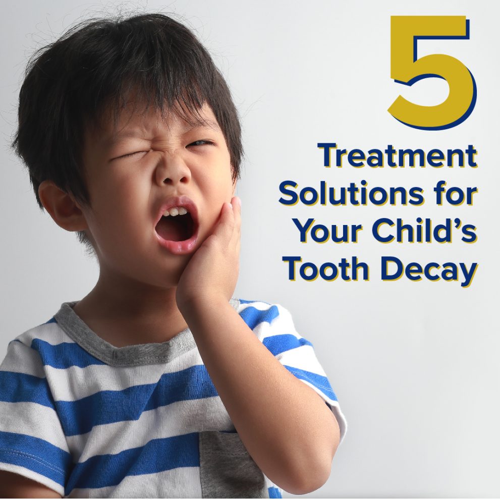Tooth Decay | Bayside Kids Dental | Odenton, MD